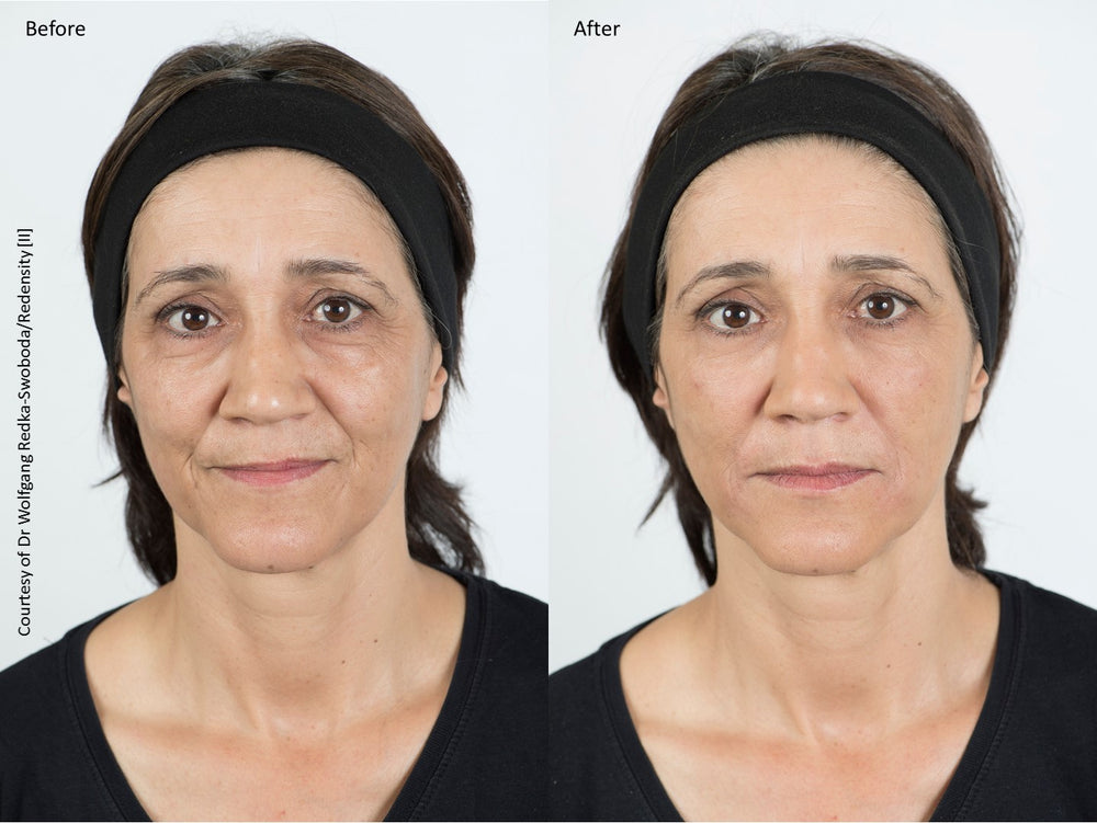 Dermal Fillers – Riverside Dental Spa
